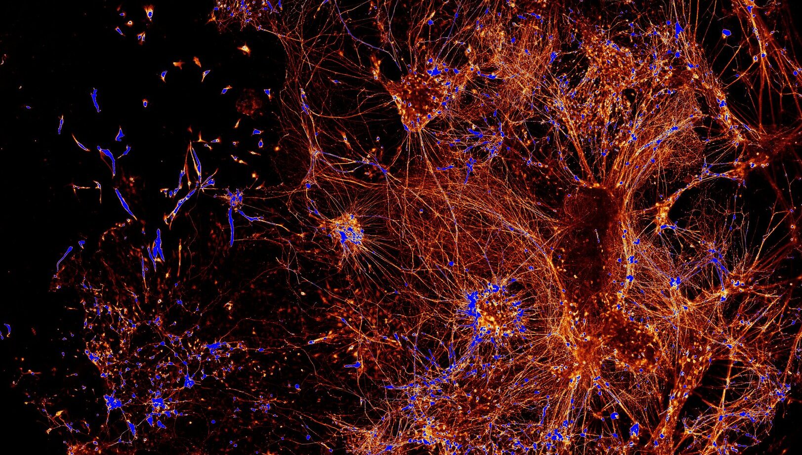 'Brain-In-A-Dish' Helps Patients Find The Right Antidepressant