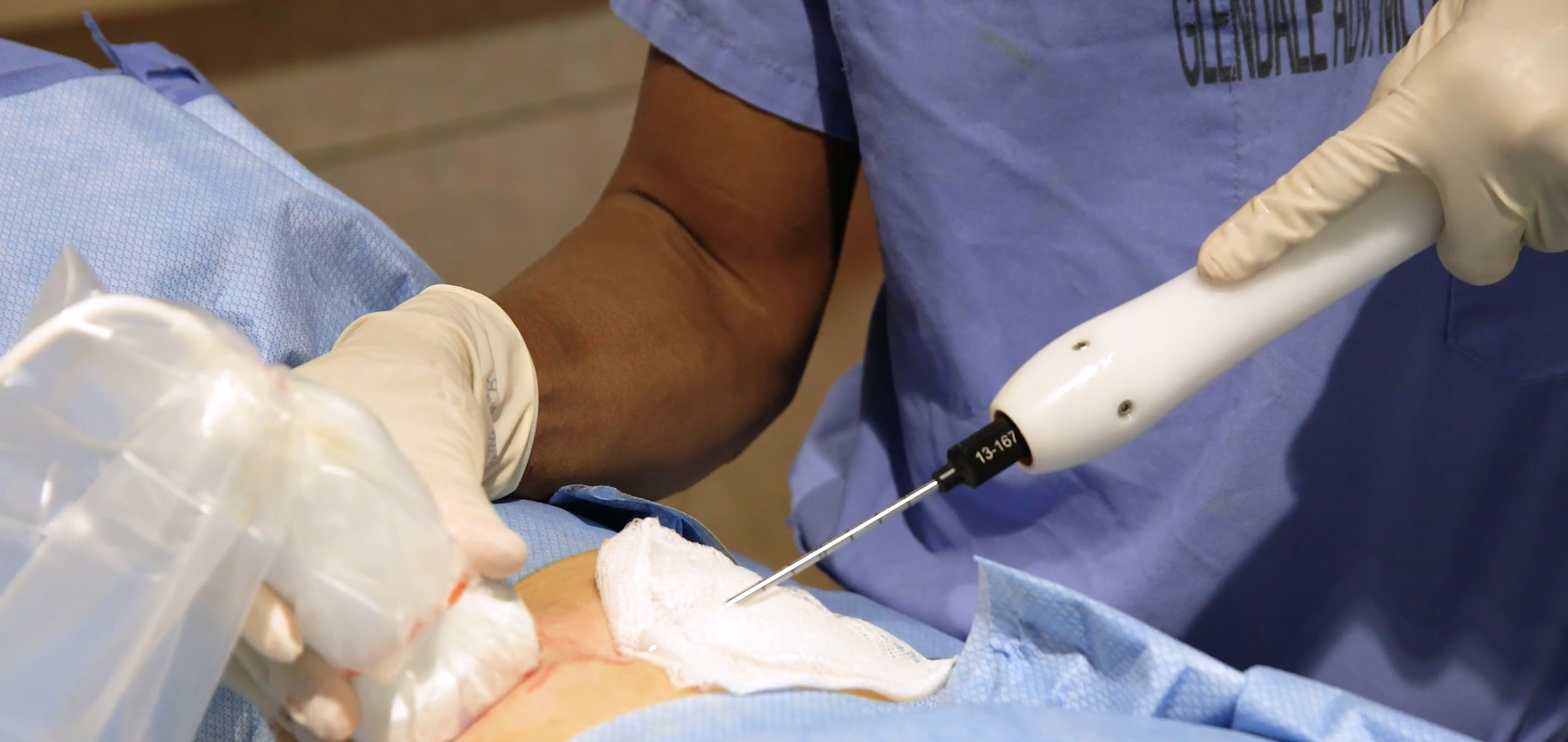 Painless Procedure: Tiny Ice Ball Kills Tumors In Minutes