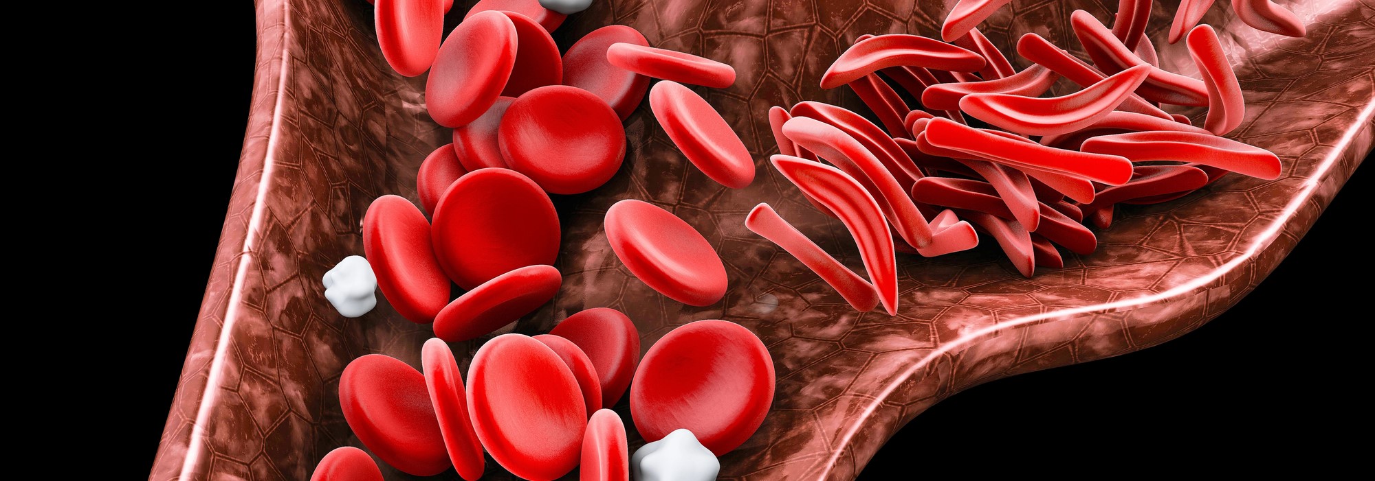 Israeli Biopharma Firm Leading US Trial Of Potential SCD Drug
