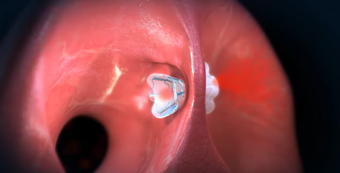 Johnson & Johnson Completes Purchase Of Israeli Startup V-Wave